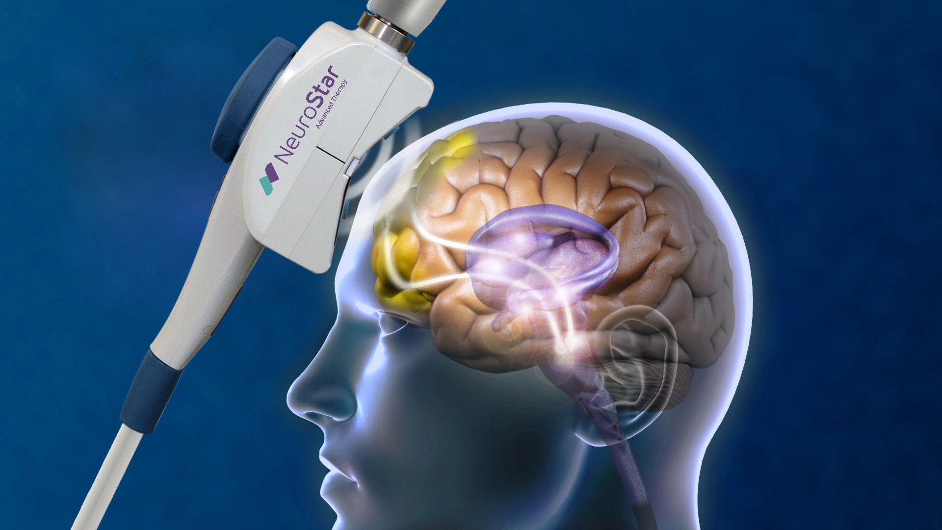 TMS Therapy TMS Therapy